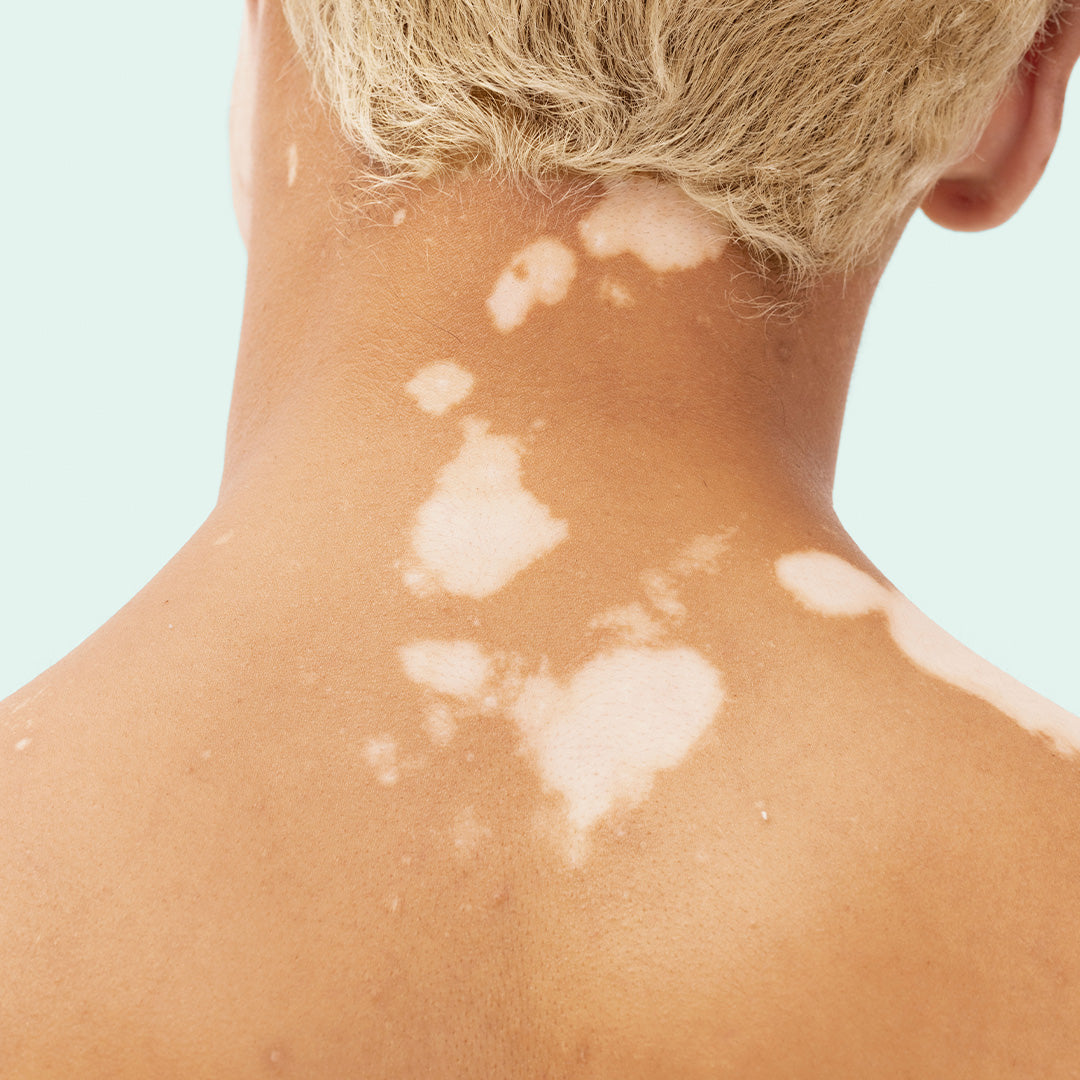 Breakthrough in Skin Science & Inflammaging - DEINDE